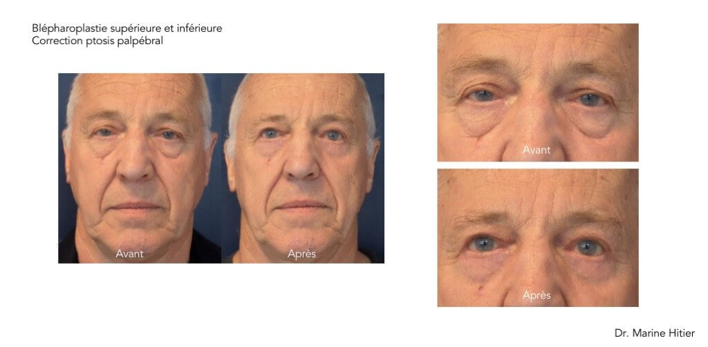 Chirurgie esthétique Blépharoplastie Annecy - Docteur MARINE HITIER